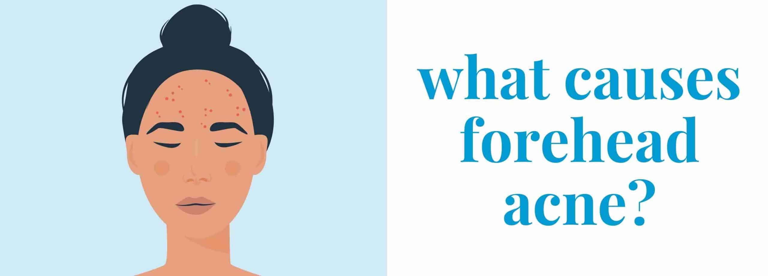 What Causes Forehead Acne And How To Get Rid Of It What Causes Forehead Acne And How To Get Rid Of It