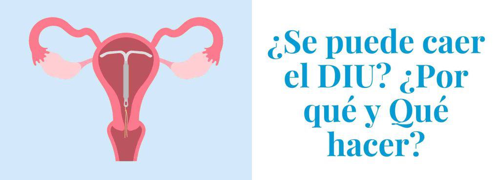 ¿Se Puede Caer El DIU? ¿Por Qué Y Qué Hacer? - Pandia Health