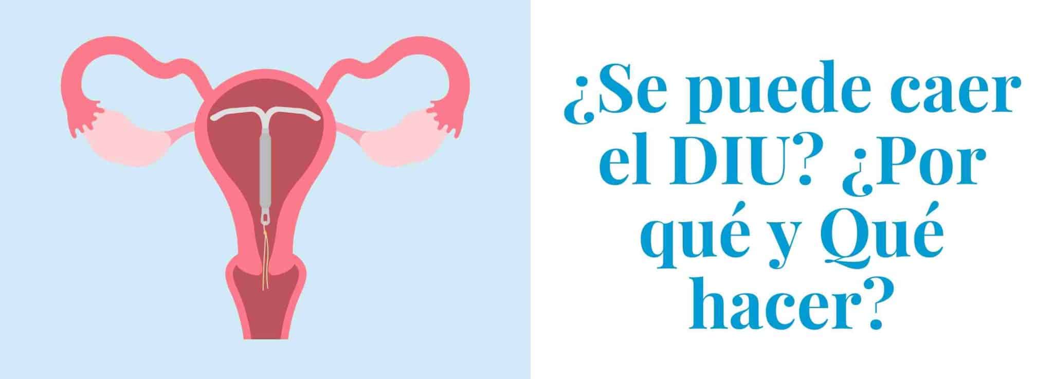 ¿Se Puede Caer El DIU? ¿Por Qué Y Qué Hacer? - Pandia Health