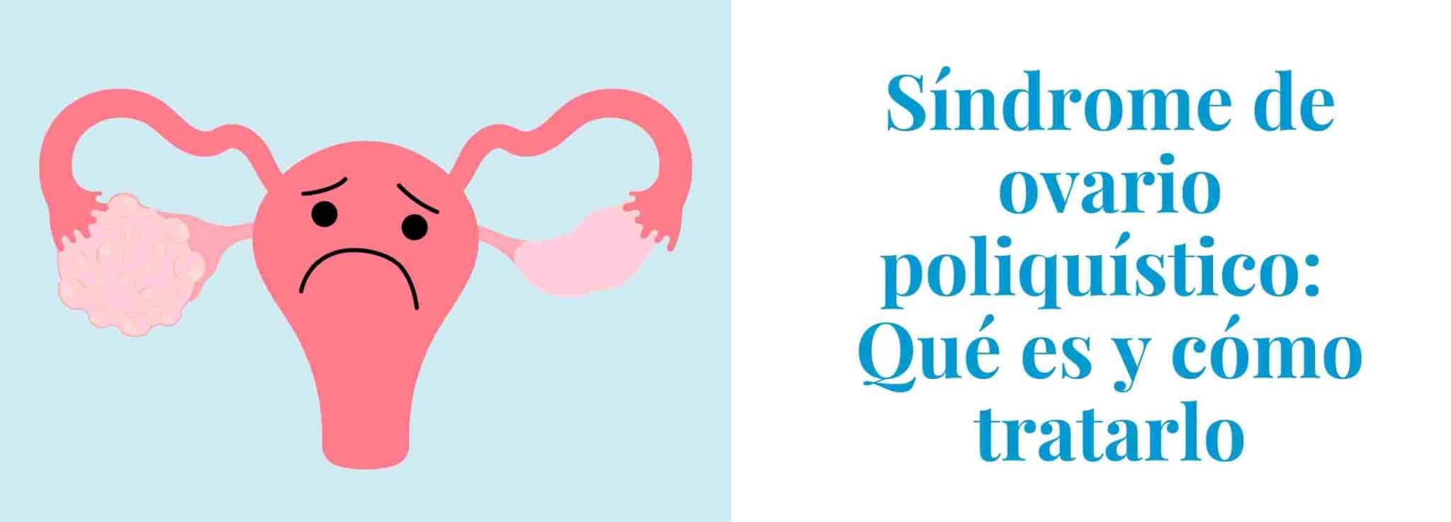 Síndrome De Ovario Poliquísticoqué Es Efectos Y Tratamiento 2586