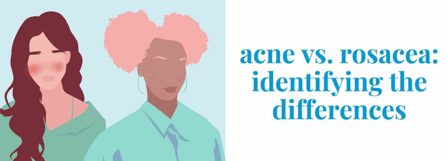 Acne Vs Rosacea: Differences, Causes And Symptoms Explained