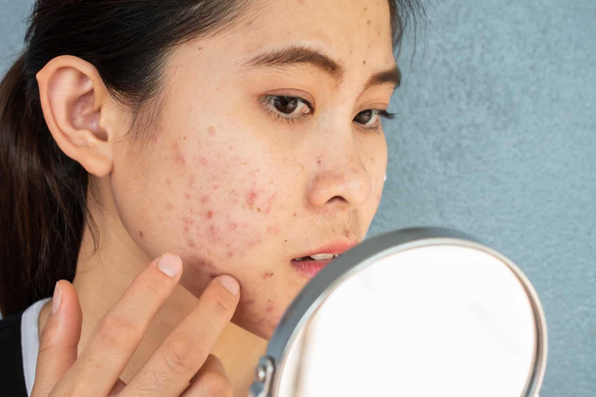Acne Vs Rosacea: Differences, Causes And Symptoms Explained