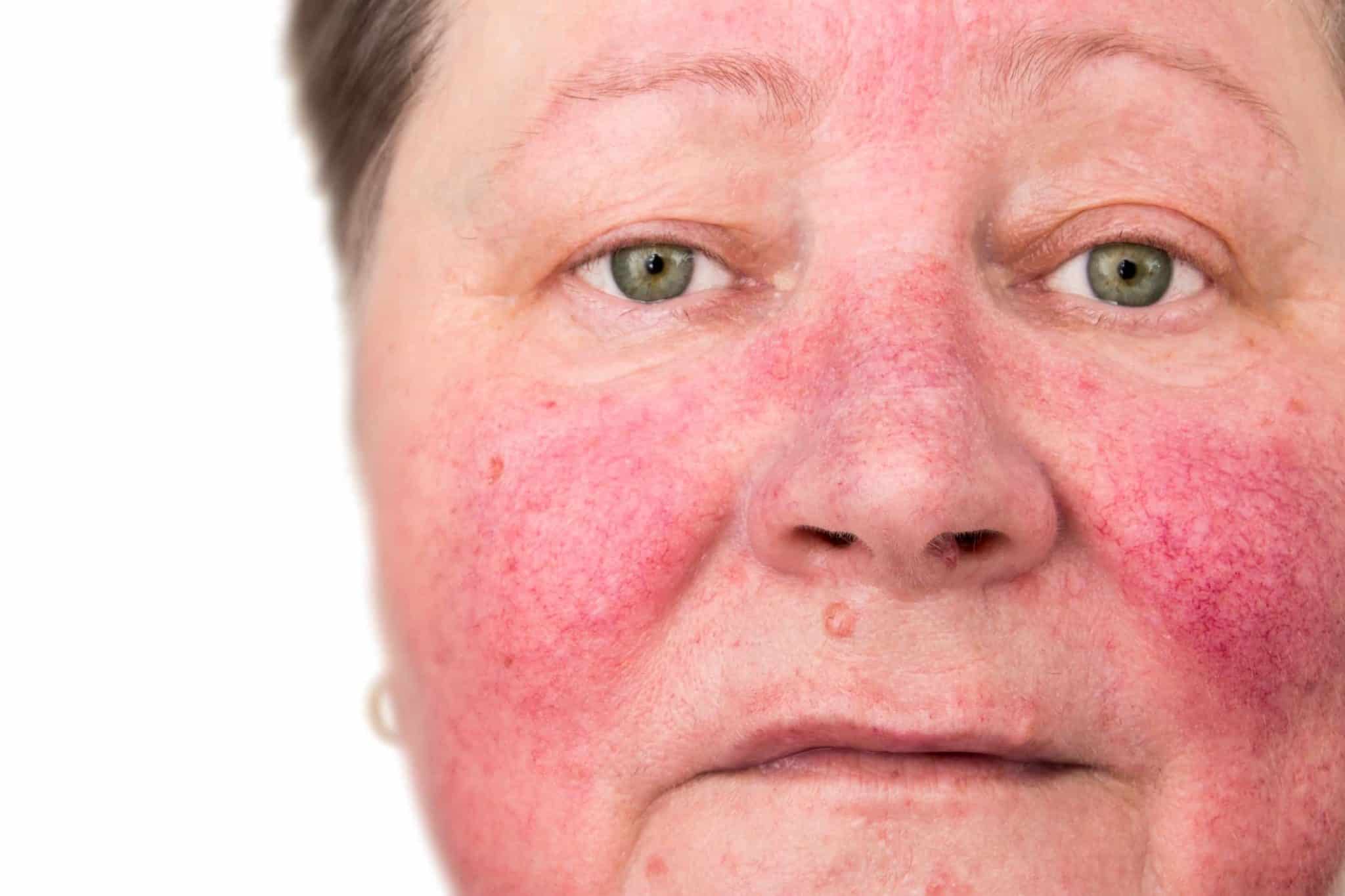 Acne Vs Rosacea: Differences, Causes And Symptoms Explained